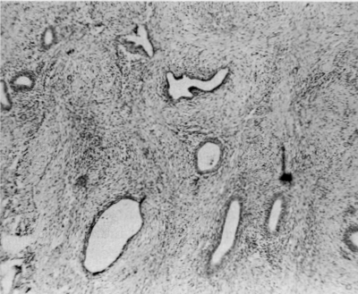 « Mülleriose: la seule théorie cohérente de l’origine de l’endométriose ...