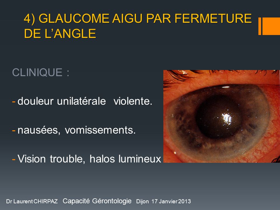 Antidépresseurs et glaucome aigu à angle fermé : nouvelles données ...